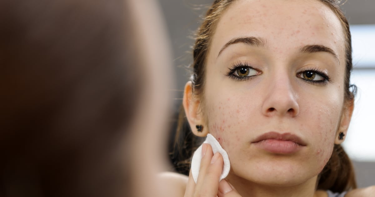 People with acne 'viewed negatively' - News - Doctors.net.uk