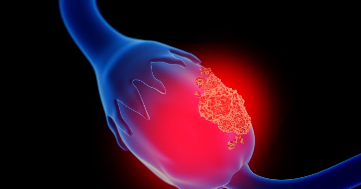 NHS hospital becomes first to offer new ovarian cancer screening test ...