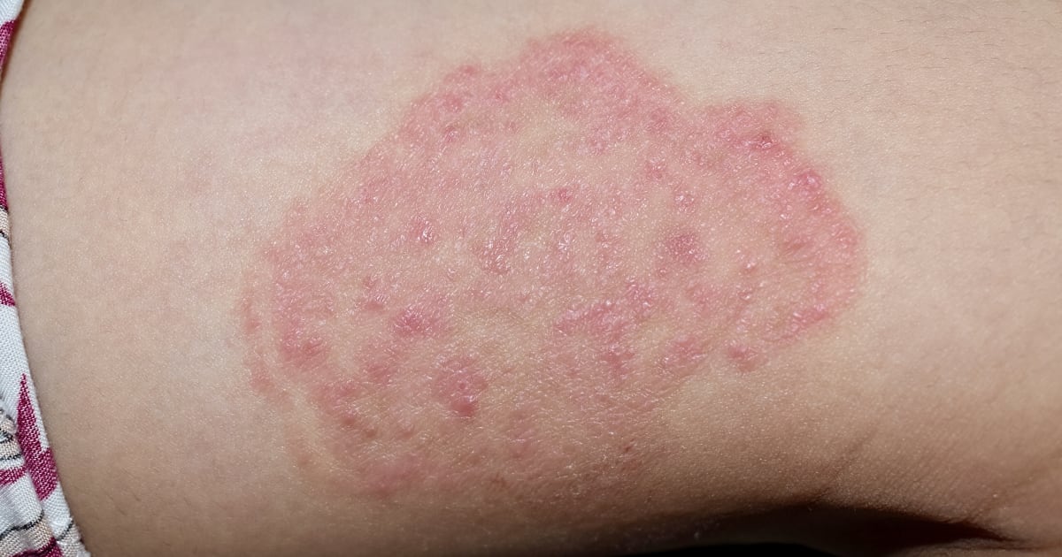 Doctors alerted about the emergence of hard-to-treat fungal skin ...