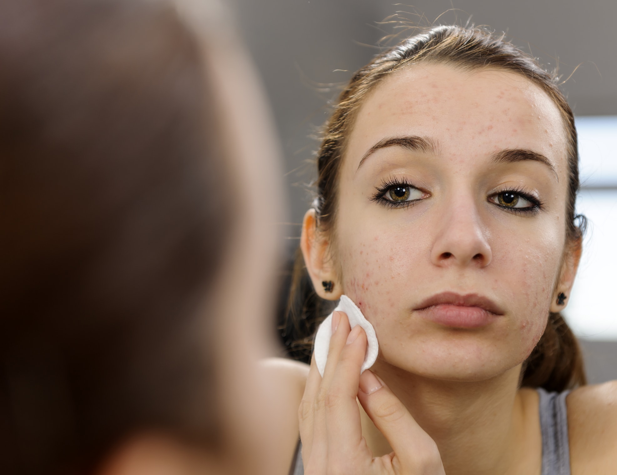 People with acne 'viewed negatively'