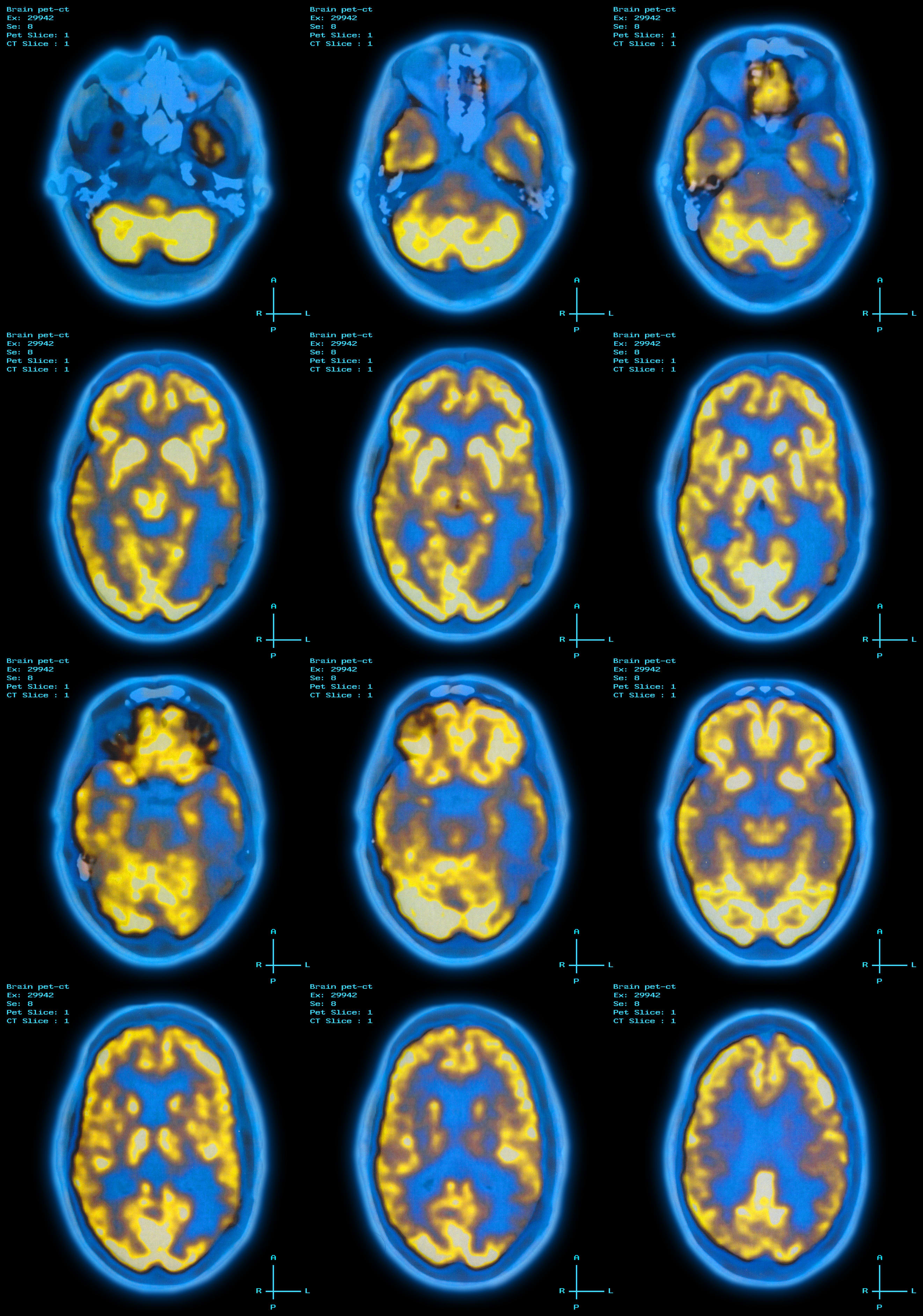Map shows brain changes linked to mental illness