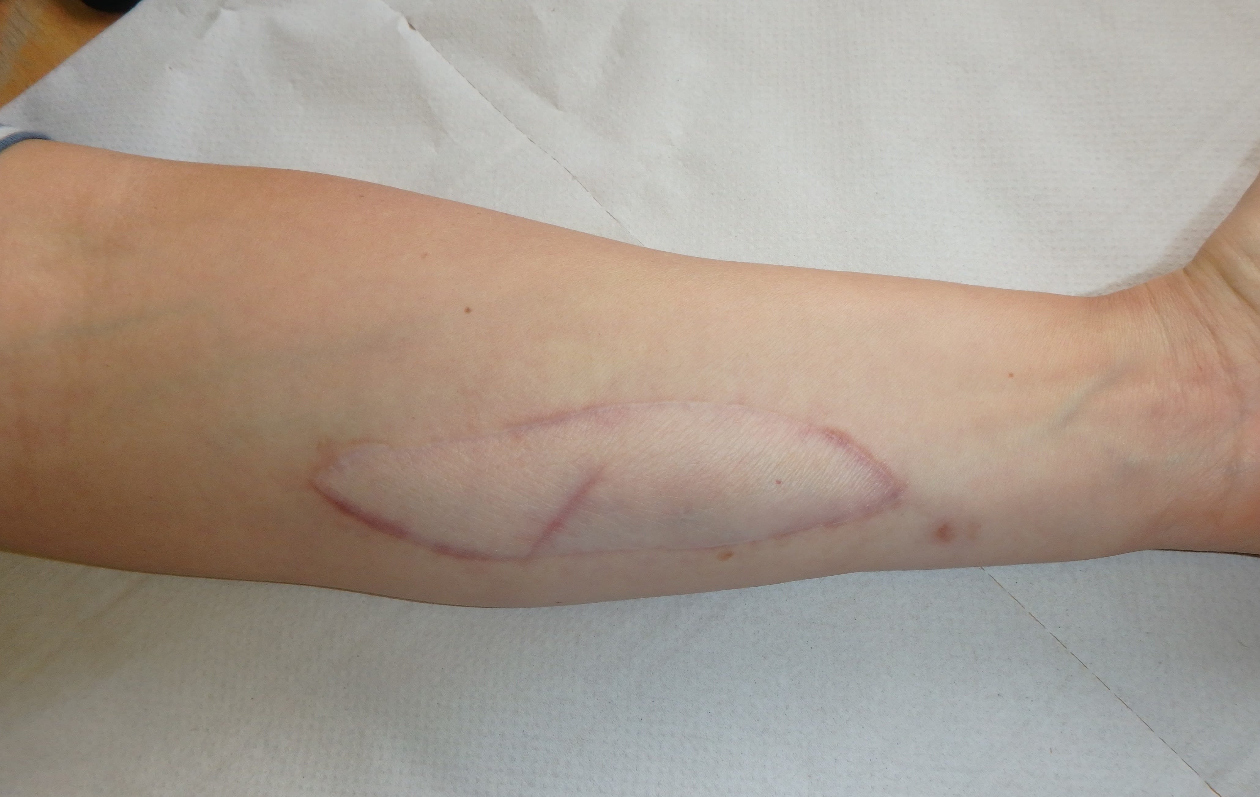 Donor skin flaps used as 'early warning system' for lung transplant ...